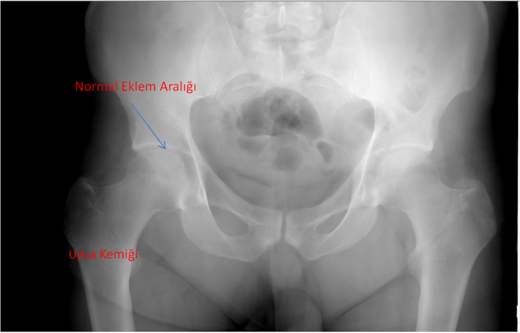 Op. Dr. Özgür Mengeş – KALÇA KİREÇLENMESİ